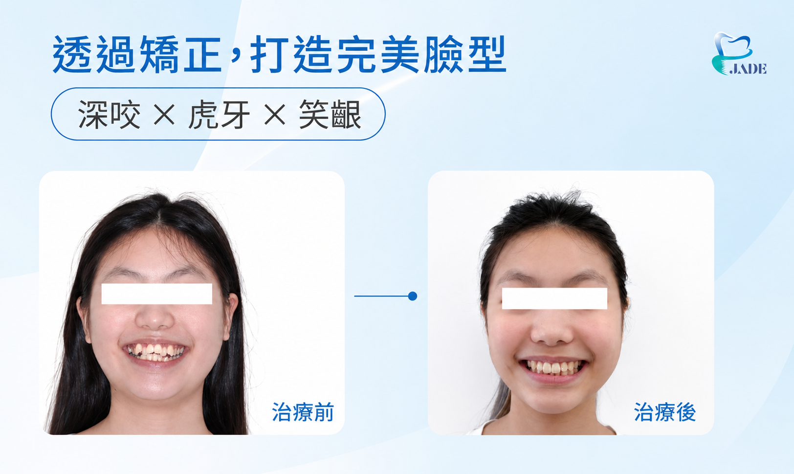 虎牙一定要矯正嗎？矯正全攻略：方法、費用與術後護理一次看懂 | 玉美學牙醫診所